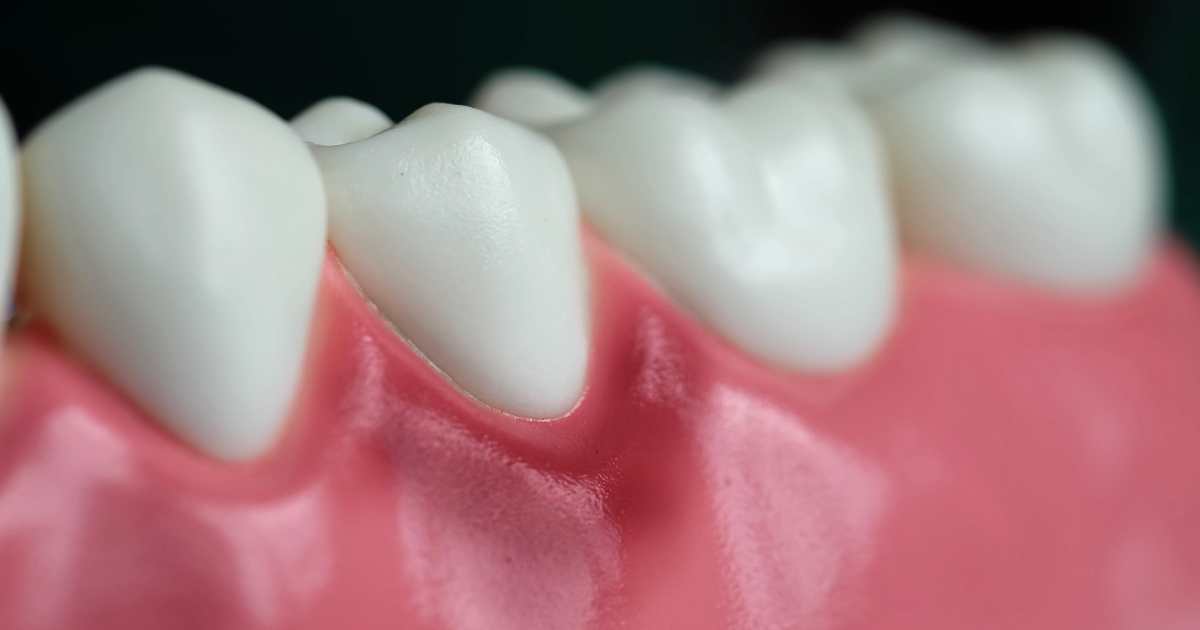Gingivitis: Causas, síntomas y tratamiento para una salud periodontal ...